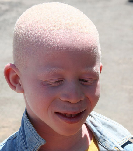 Lives of persons living with albinism matter | FairPlanet